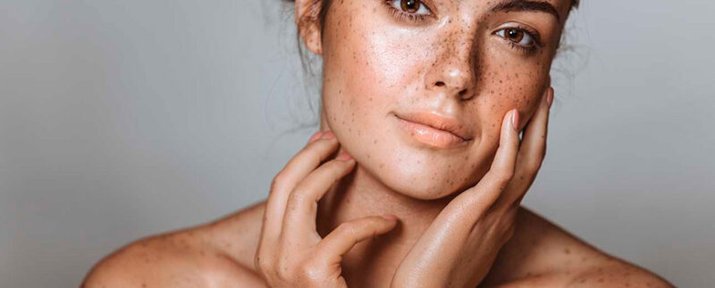 Melasma en la piel: causas, síntomas y cómo eliminarlo eficazmente ...