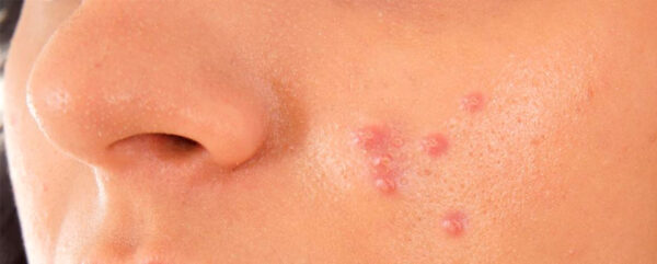 Pústulas: ¿qué son y cómo curarlas? | Blog Druni