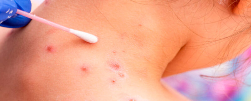 Pústulas: ¿qué son y cómo curarlas? | Blog Druni