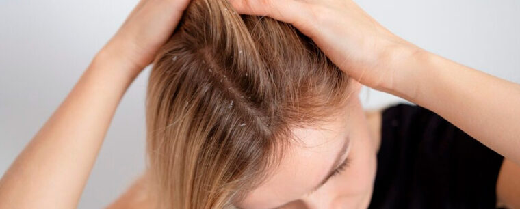 Cómo eliminar la caspa en un día: ¡Recupera tu cabello limpio y ...