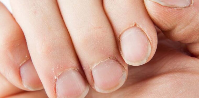 ¿Qué son los uñeros? ¿Cómo curarlos correctamente? Te lo contamos ...