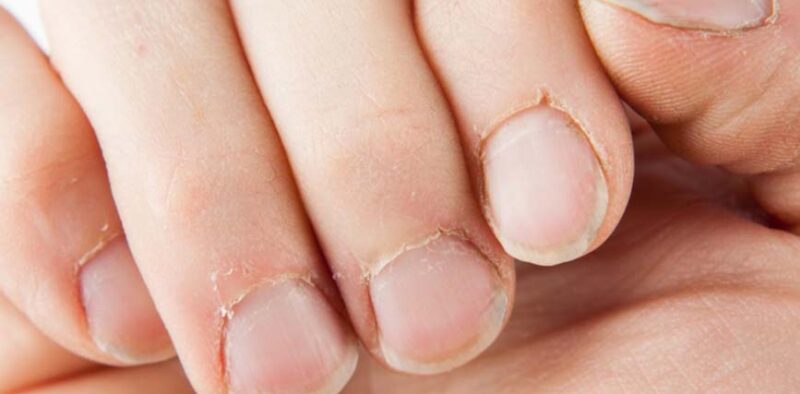 ¿Qué son los uñeros? ¿Cómo curarlos correctamente? Te lo contamos ...