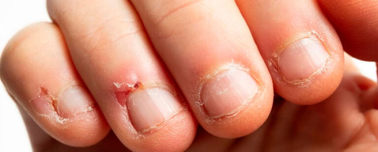 Cómo curar un padrastro infectado | Blog Druni