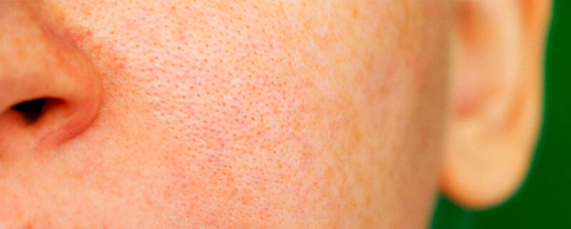 Melasma facial: qué es, cómo evitarlo y los mejores tratamientos | Blog ...