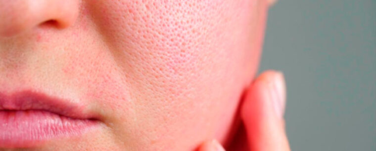 Exceso de sebo en la piel: Causas y soluciones efectivas | Blog Druni