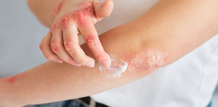 Descamación en la piel: Causas más comunes y cómo tratarla eficazmente ...