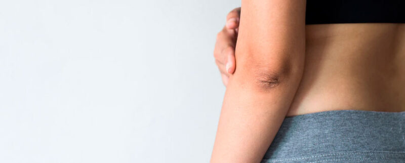 Codos secos y oscuros: Soluciones sencillas para mejorar su aspecto ...