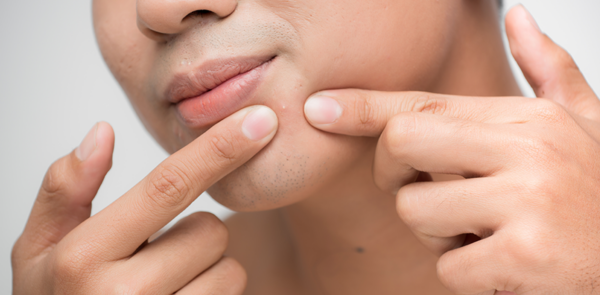 Exceso de sebo en la piel: Causas y soluciones efectivas | Blog Druni