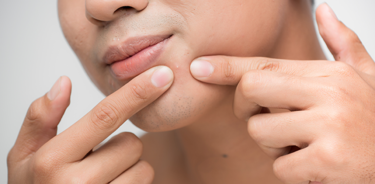 Exceso de sebo en la piel: Causas y soluciones efectivas | Blog Druni