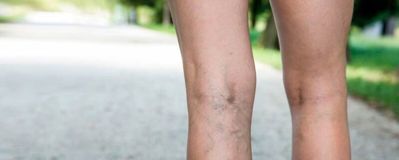 Por qué aparecen las venas varices y cómo evitarlas | Blog Druni