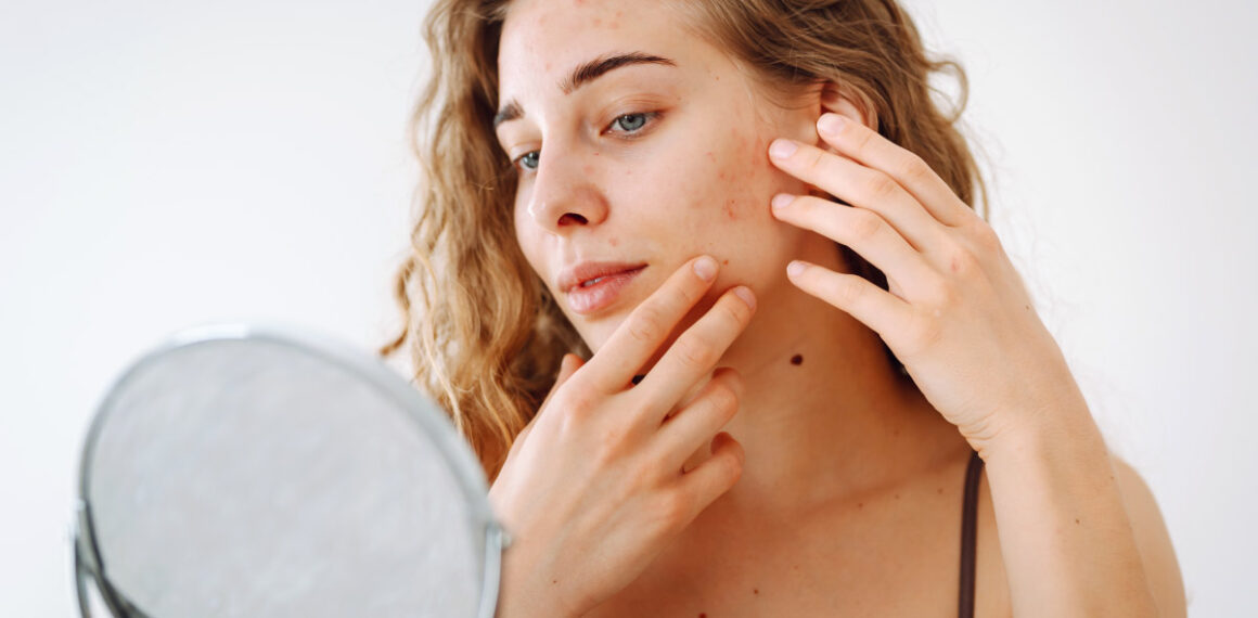 Pústulas: ¿qué son y cómo curarlas? | Blog Druni