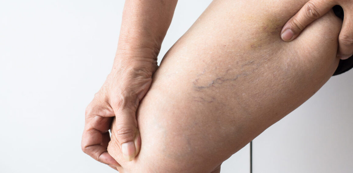 Por qué aparecen las venas varices y cómo evitarlas | Blog Druni