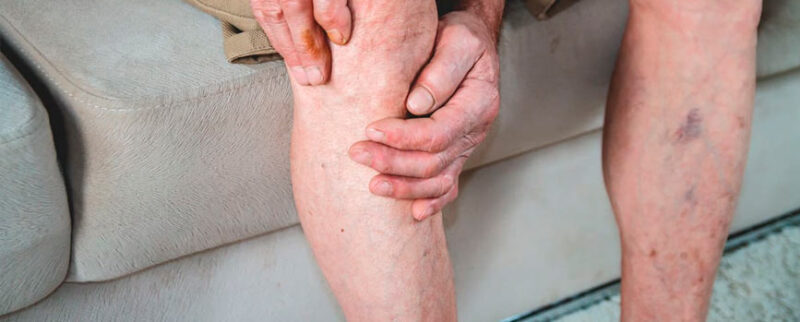 Varices en hombres: causas, síntomas y cómo tratarlas | Blog Druni