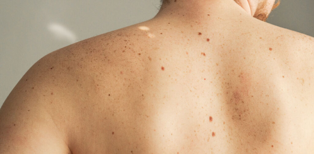 ¿Qué son las pecas y por qué salen? | Blog Druni