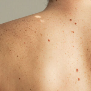 Cuidado íntimo: Métodos seguros para aclarar la zona íntima de forma ...