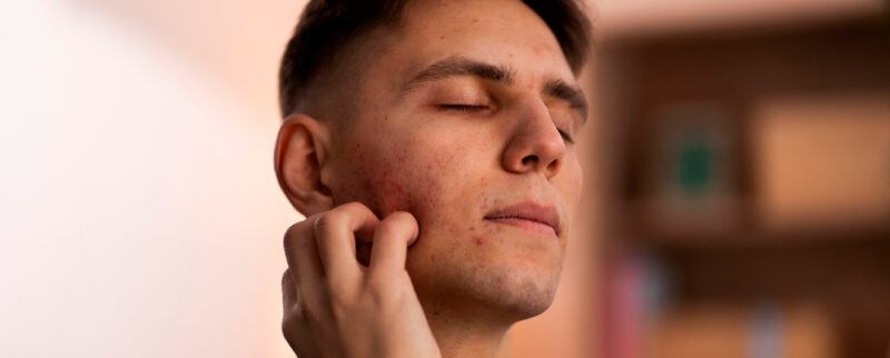 Hongos en la cara: causas, síntomas y tratamiento | Blog Druni