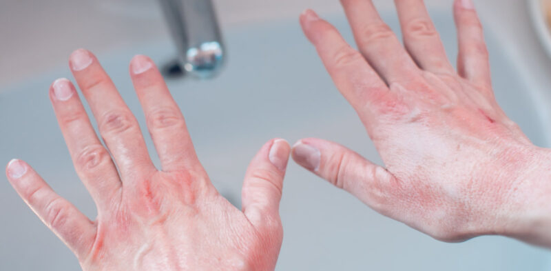 ¿Qué son los uñeros? ¿Cómo curarlos correctamente? Te lo contamos ...