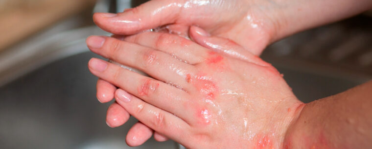 Hongos en las manos: causas, síntomas y tratamiento | Blog Druni