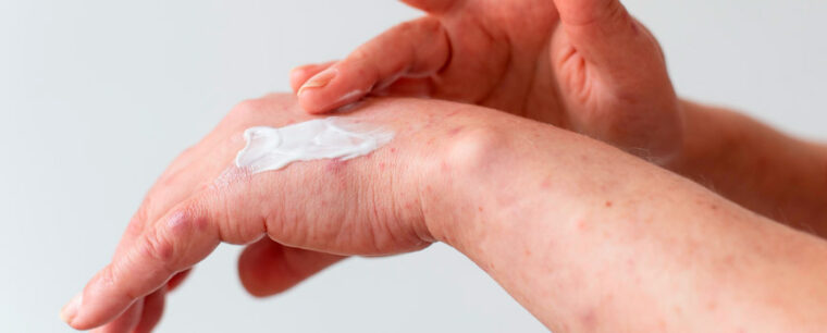 Hongos en las manos: causas, síntomas y tratamiento | Blog Druni