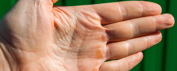 Callos en las manos: tipos y cómo quitarlos | Blog Druni