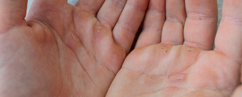 Callos en las manos: tipos y cómo quitarlos | Blog Druni