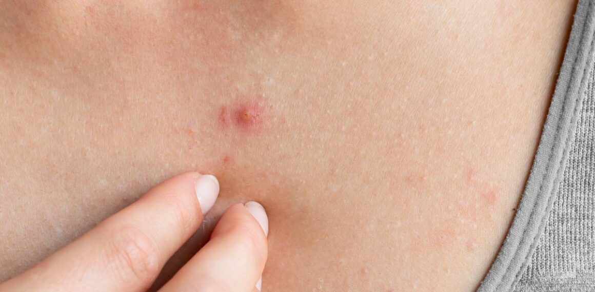 Guía completa sobre la foliculitis: qué es, causas y cómo tratarla ...