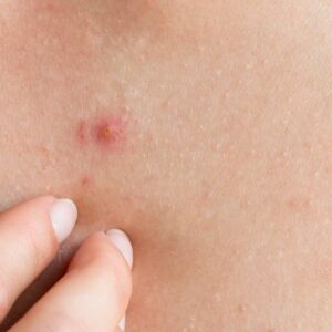 Granos en el labio: qué hacer y cómo tratarlos | Blog Druni