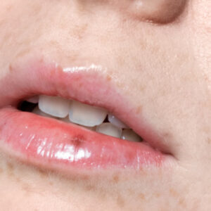 ¿Qué son los granos y cómo quitarlos? | Blog Druni