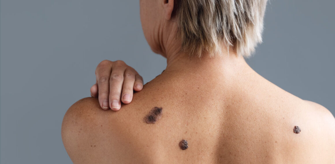 Hongos en la cara: causas, síntomas y tratamiento | Blog Druni
