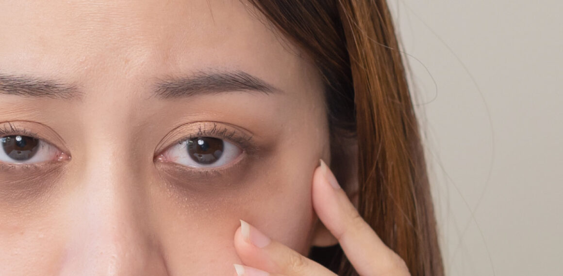 Ojeras moradas: ¿Qué son y cómo quitarlas? | Blog Druni