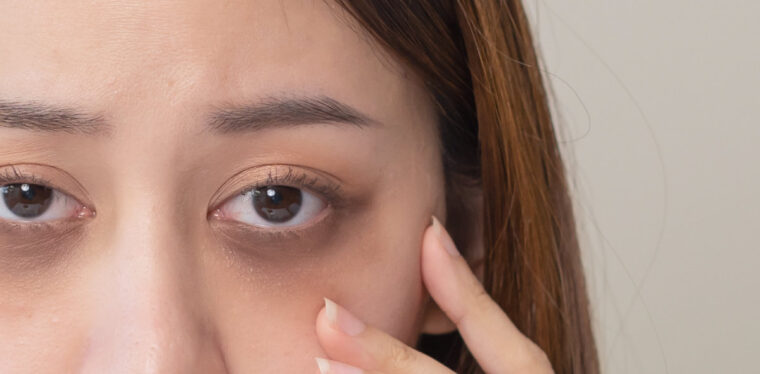 Ojeras moradas: ¿Qué son y cómo quitarlas? | Blog Druni