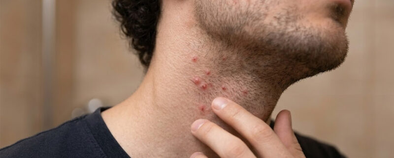Guía completa sobre la foliculitis: qué es, causas y cómo tratarla ...